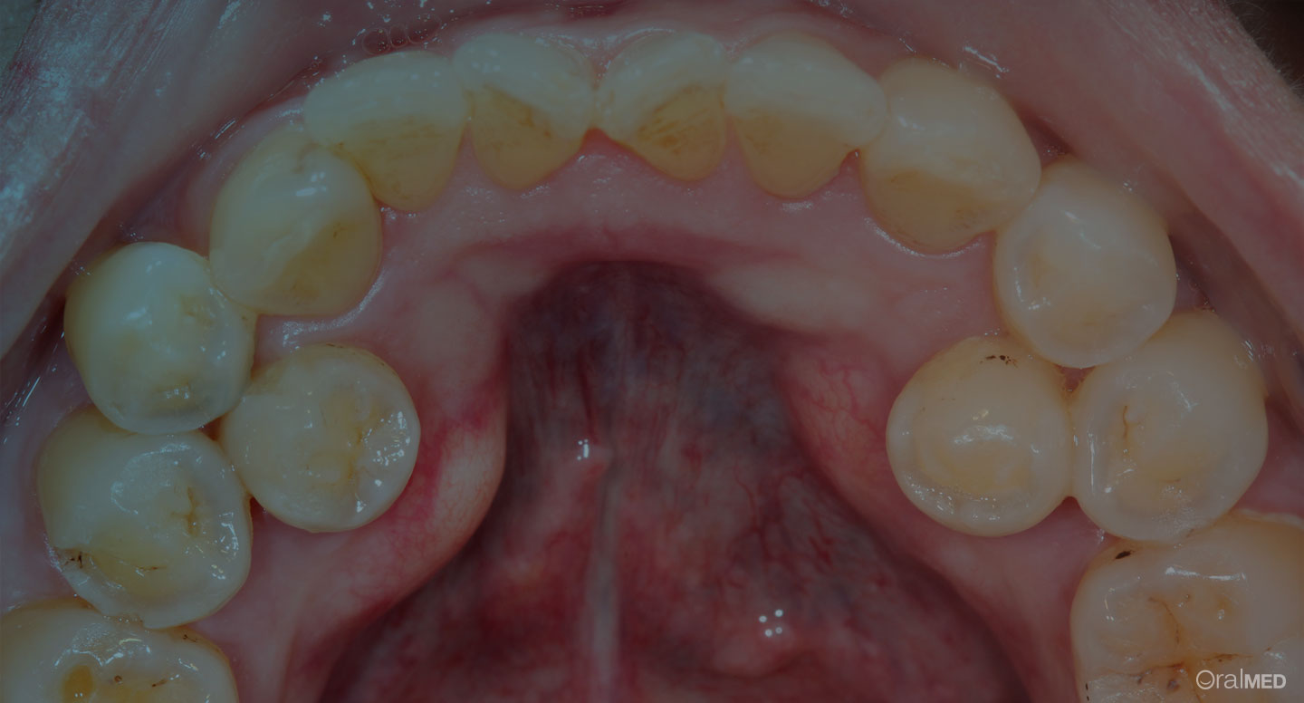 Dentes a mais? Acontece, mas tem solução! | OralMED